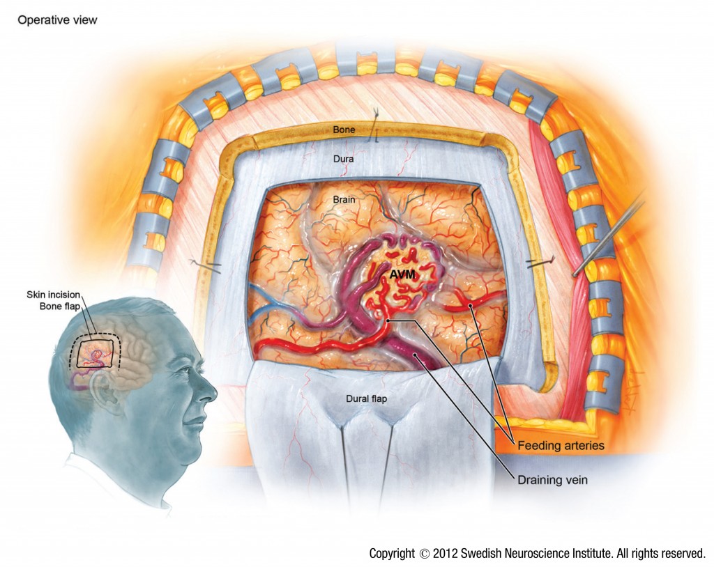 Cerebral Arteriovenous Malformations - SeattleNeurosciences.com